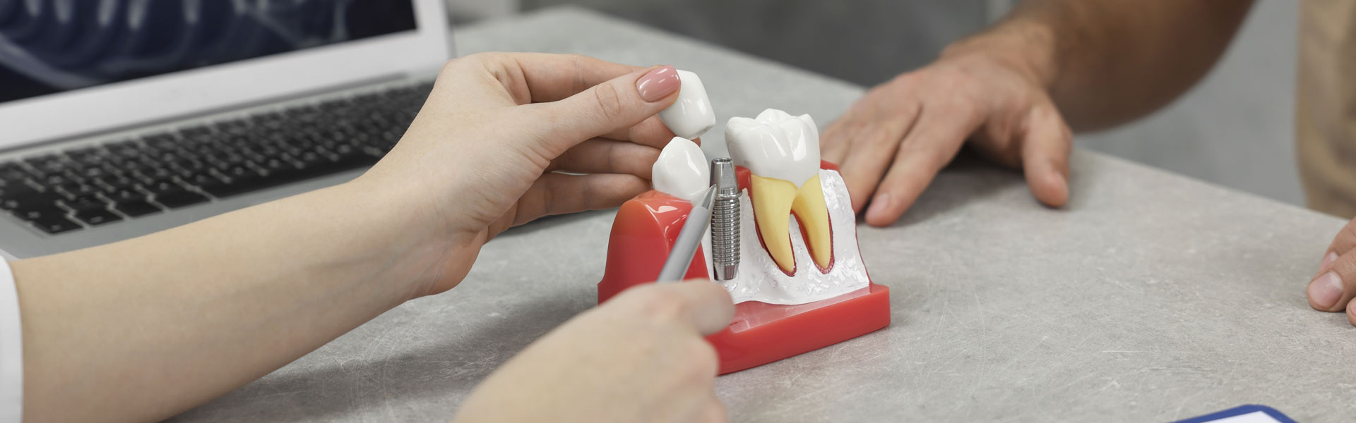 How Bone Graft Can Help in Achieving a More Stable Dental Implant